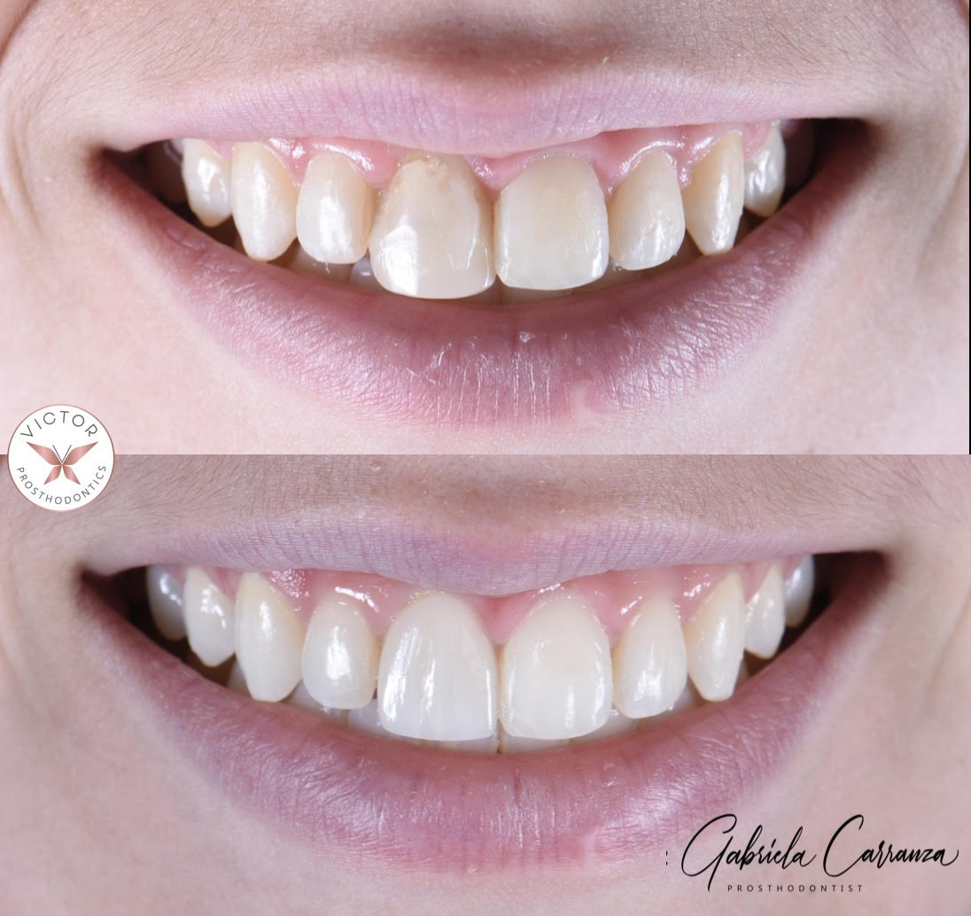 All About Veneers - Victor Prosthodontics