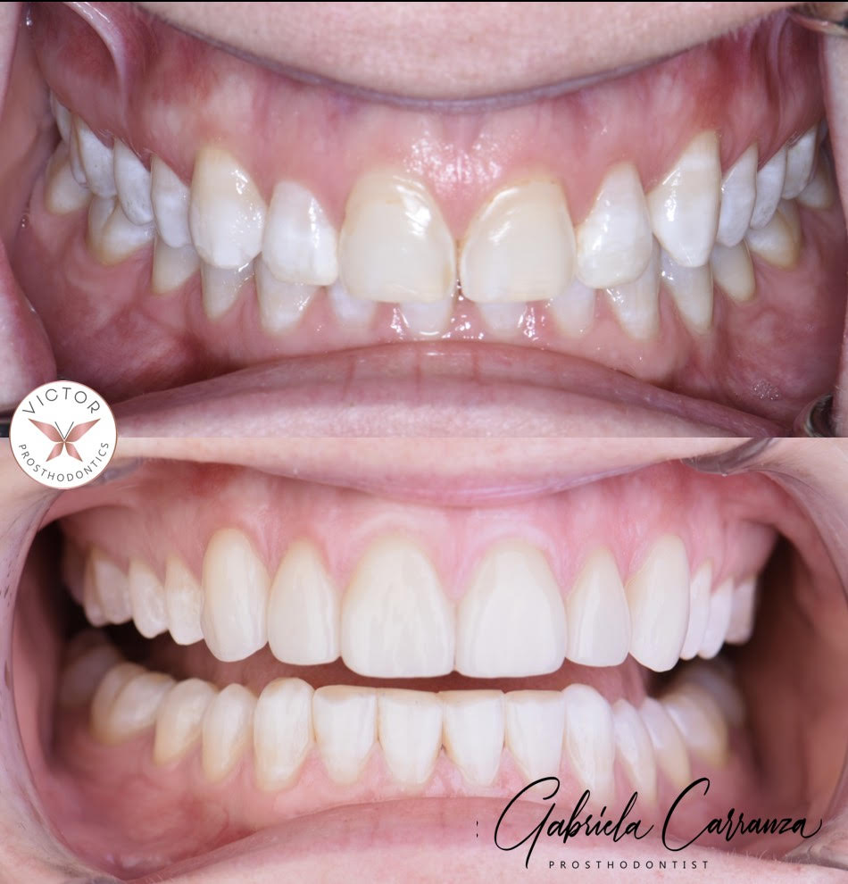 All About Veneers - Victor Prosthodontics