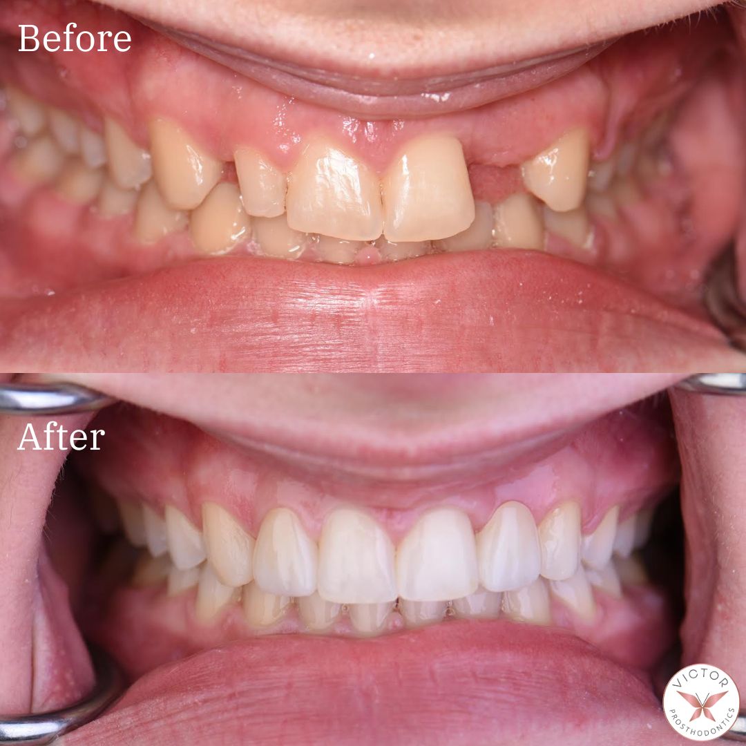 Maryland Bridges - A Suitable Option for Children - Victor Prosthodontics