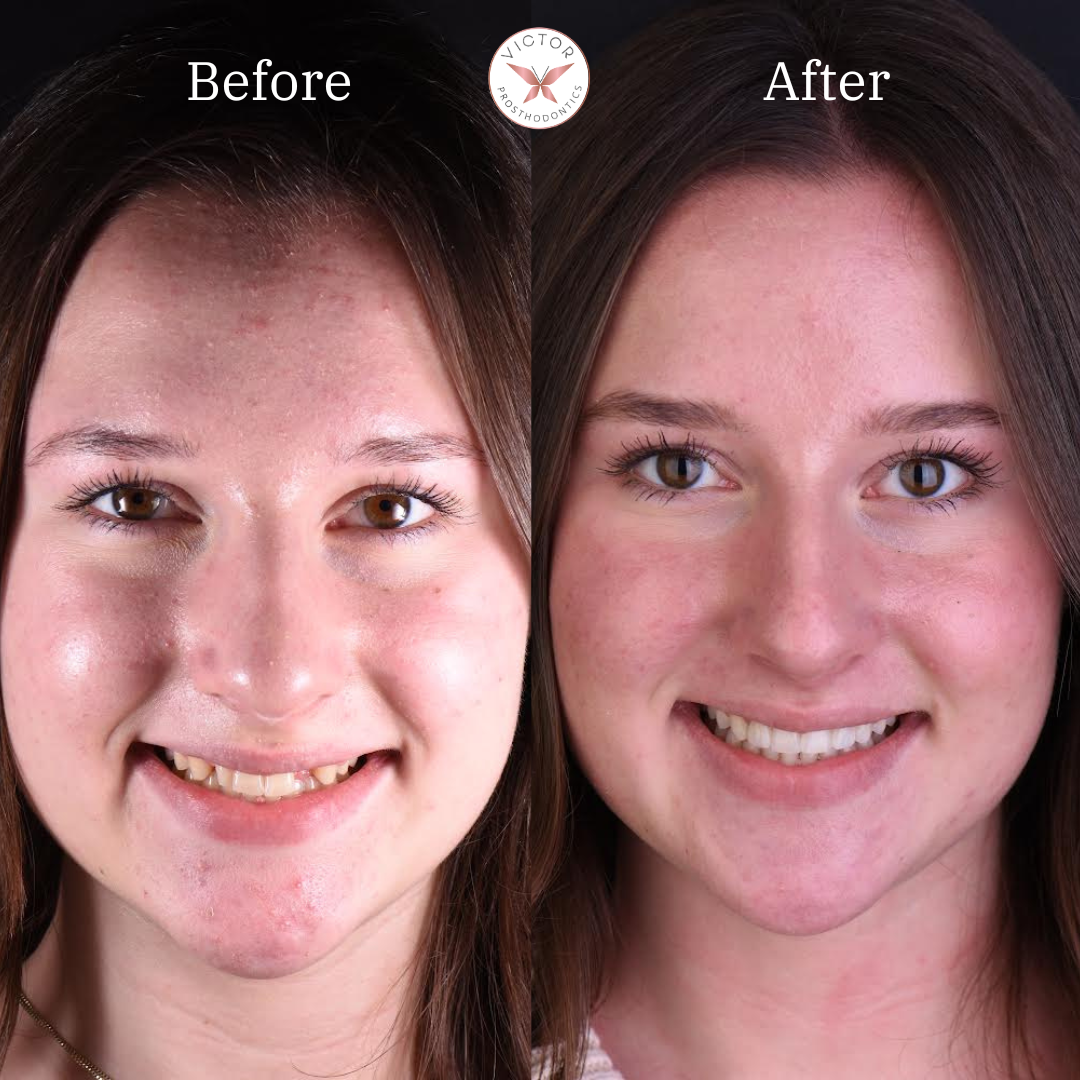 Maryland Bridges - A Suitable Option for Children - Victor Prosthodontics